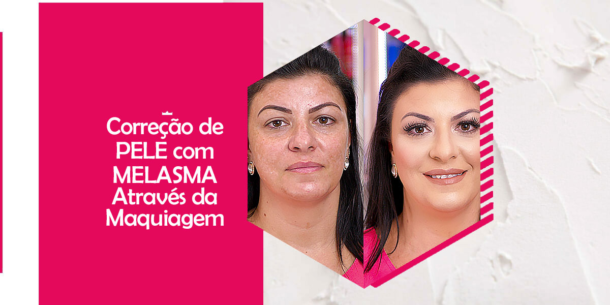 Correção de pele com Melasma Forever Liss - Blog ForeverLiss